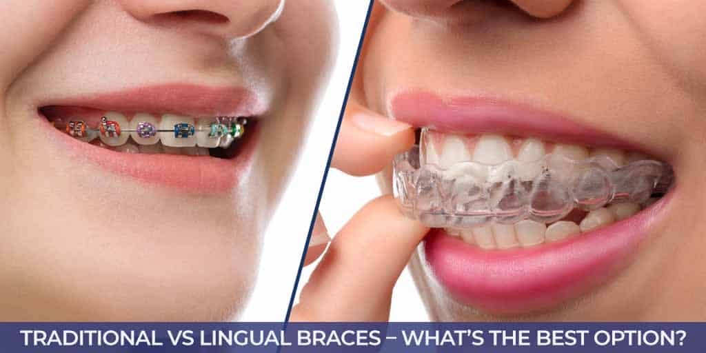 lingual braces