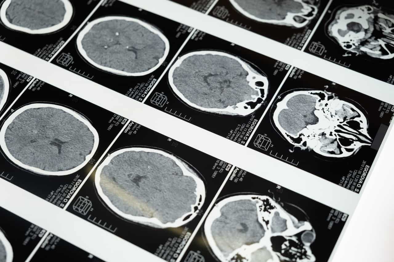 Traumatic Brain Injury (TBI): Symptoms, Causes, and Treatment Options