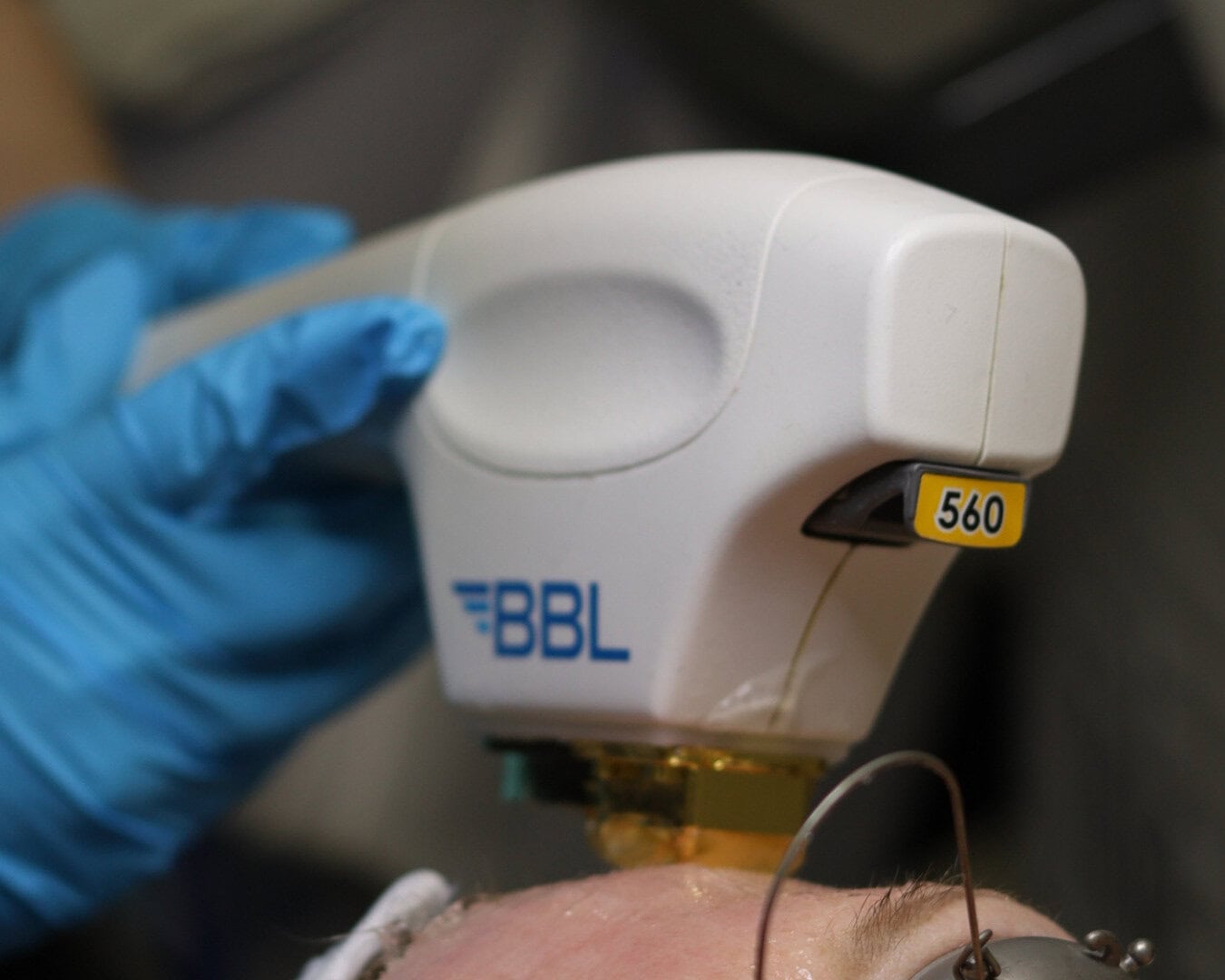 BBL® Forever Clear™ - Current Facial Plastic Surgery & Medspa