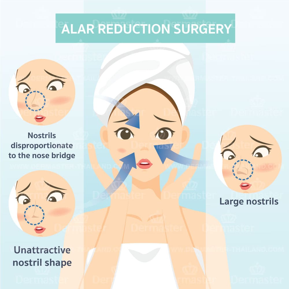 Alar Reduction Surgery Looks More Prominent - Dermaster