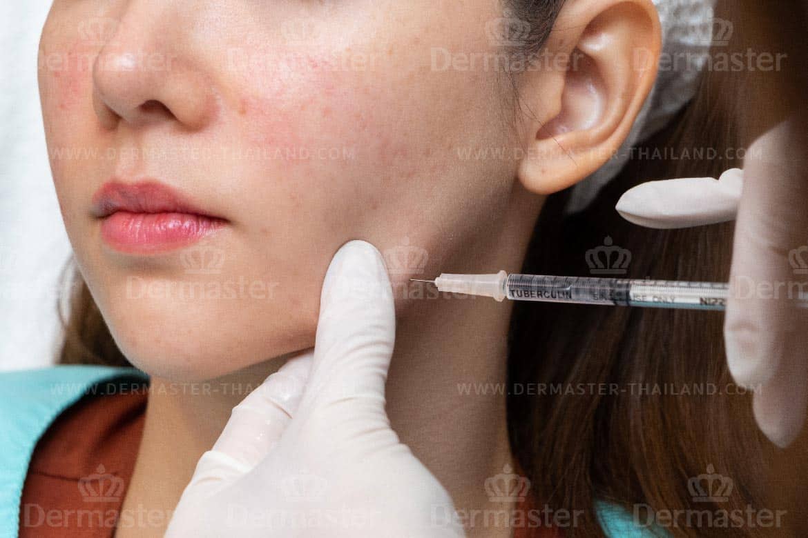 Meso F Lift Fat Removal Injection - Dermaster Beauty Clinic