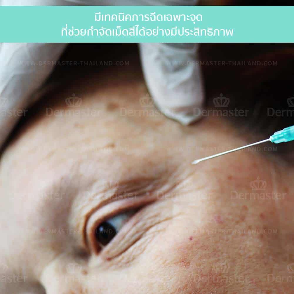 Transamine ลดฝ้า กระ รอยดำจากสิว - Dermaster สถาบันความงาม