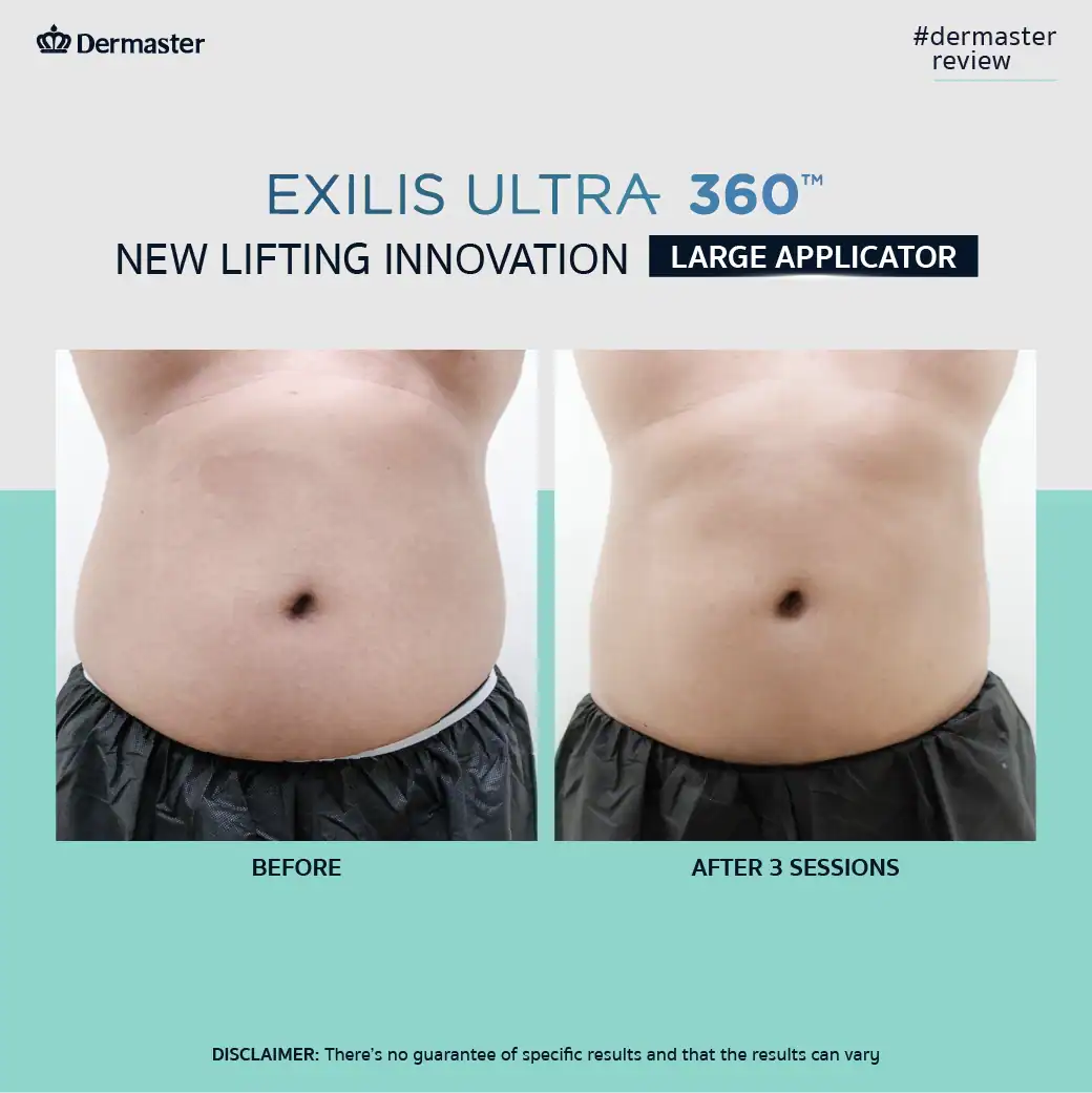 Exilis Ultra 360 Ultimate RF & Ultrasound Lift At Dermaster