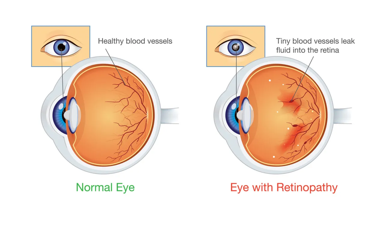 Can Diabetic Retinopathy be Reversed? Treatment Insights