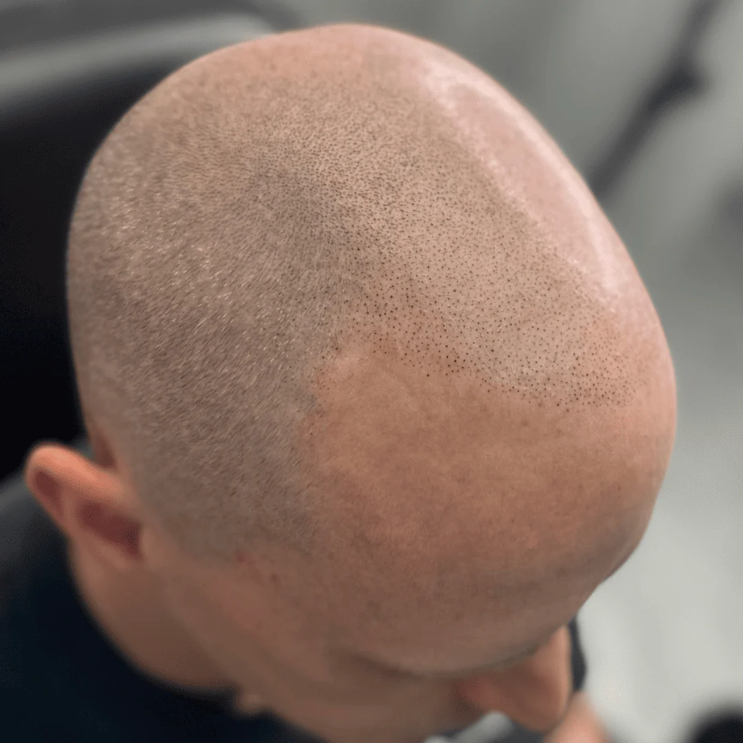 SCALP MICROPIGMENTATION Michigan - Fine Strokes Microblading