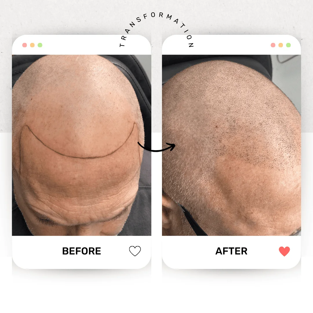 SCALP MICROPIGMENTATION Michigan - Fine Strokes Microblading