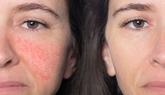 Kuperoza - Uzroci i Rešenje | Pre Svega Nega