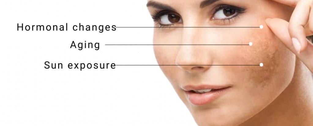 How To Cure Melasma Naturally? Best Tips For Stunning Skin
